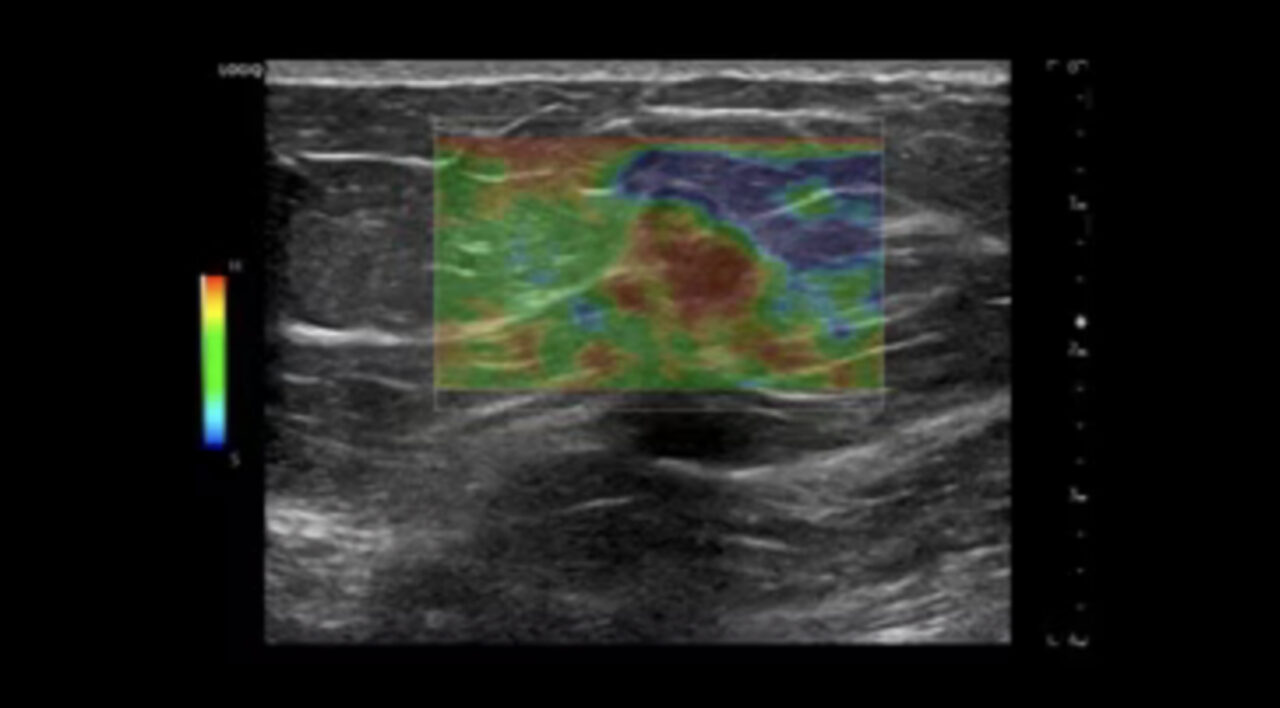 Elastography - McAllen Breast Imaging